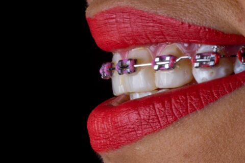 Braces vs Aligners: Pros, Cons, and Costs for Detroit Families
